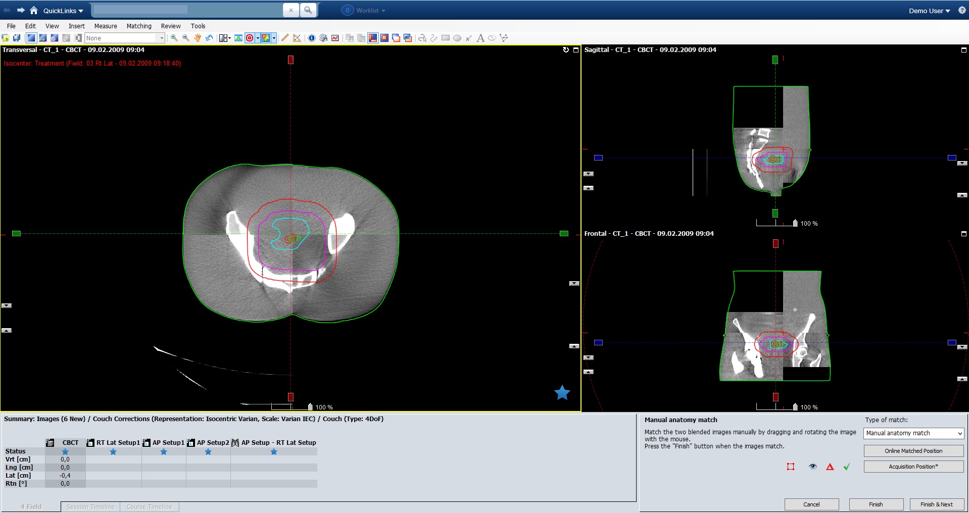 ARIA® OIS FOR RADIATION ONCOLOGY - PAPAPOSTOLOU