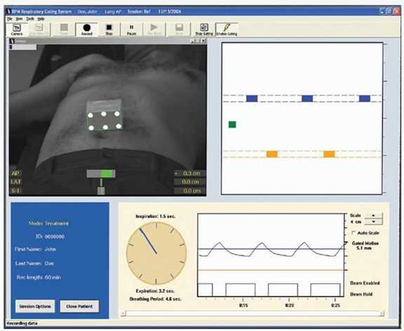 Respiratory Gating System Archives - PAPAPOSTOLOU
