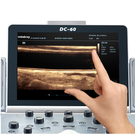 Υπέρηχος Mindray DC-60 - HOLOGIC - ΠΑΠΑΠΟΣΤΟΛΟΥ