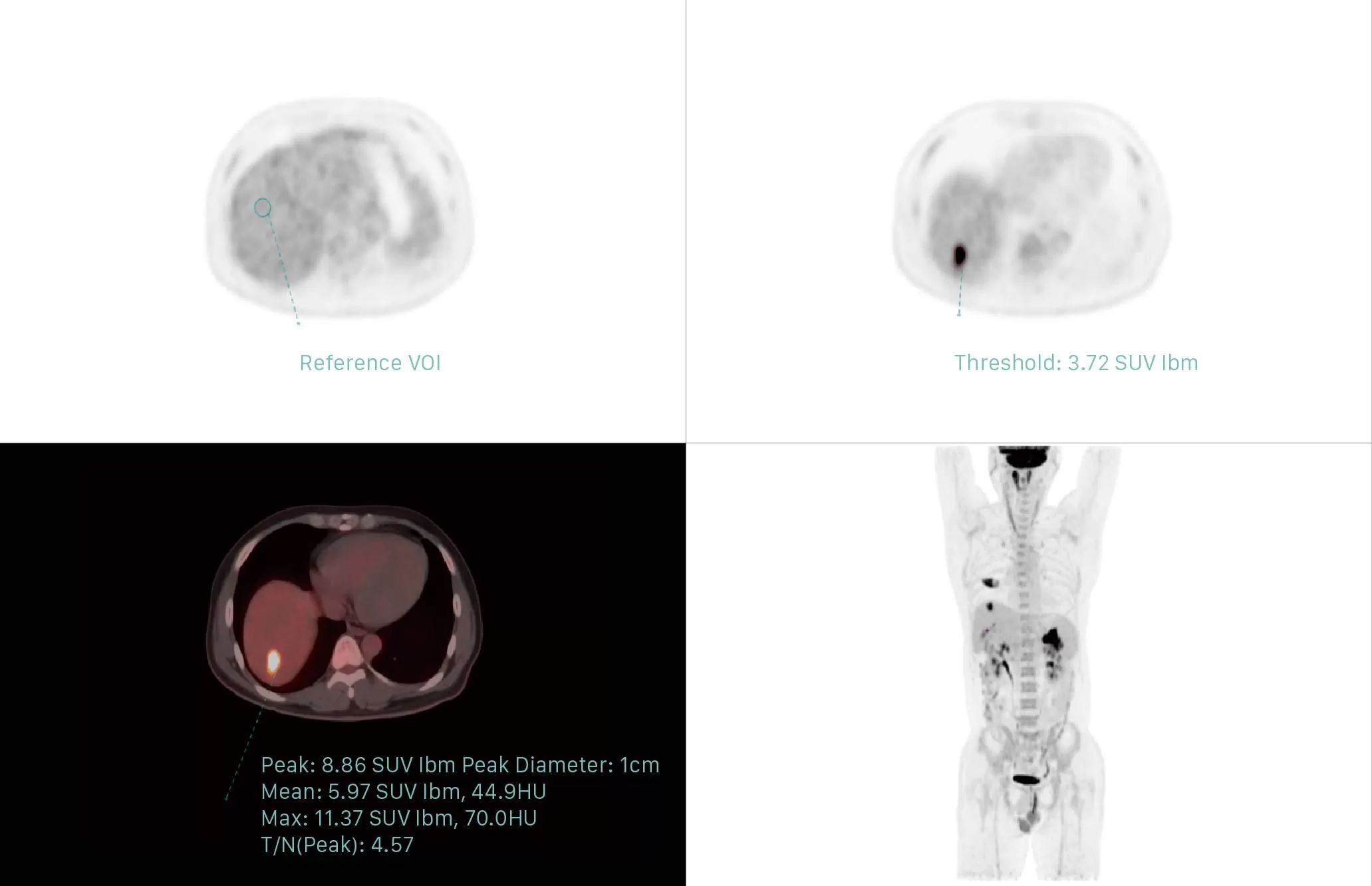 uMI 780 | Ultra-Fast High-Resolution Digital PET/CT - ΠΑΠΑΠΟΣΤΟΛΟΥ