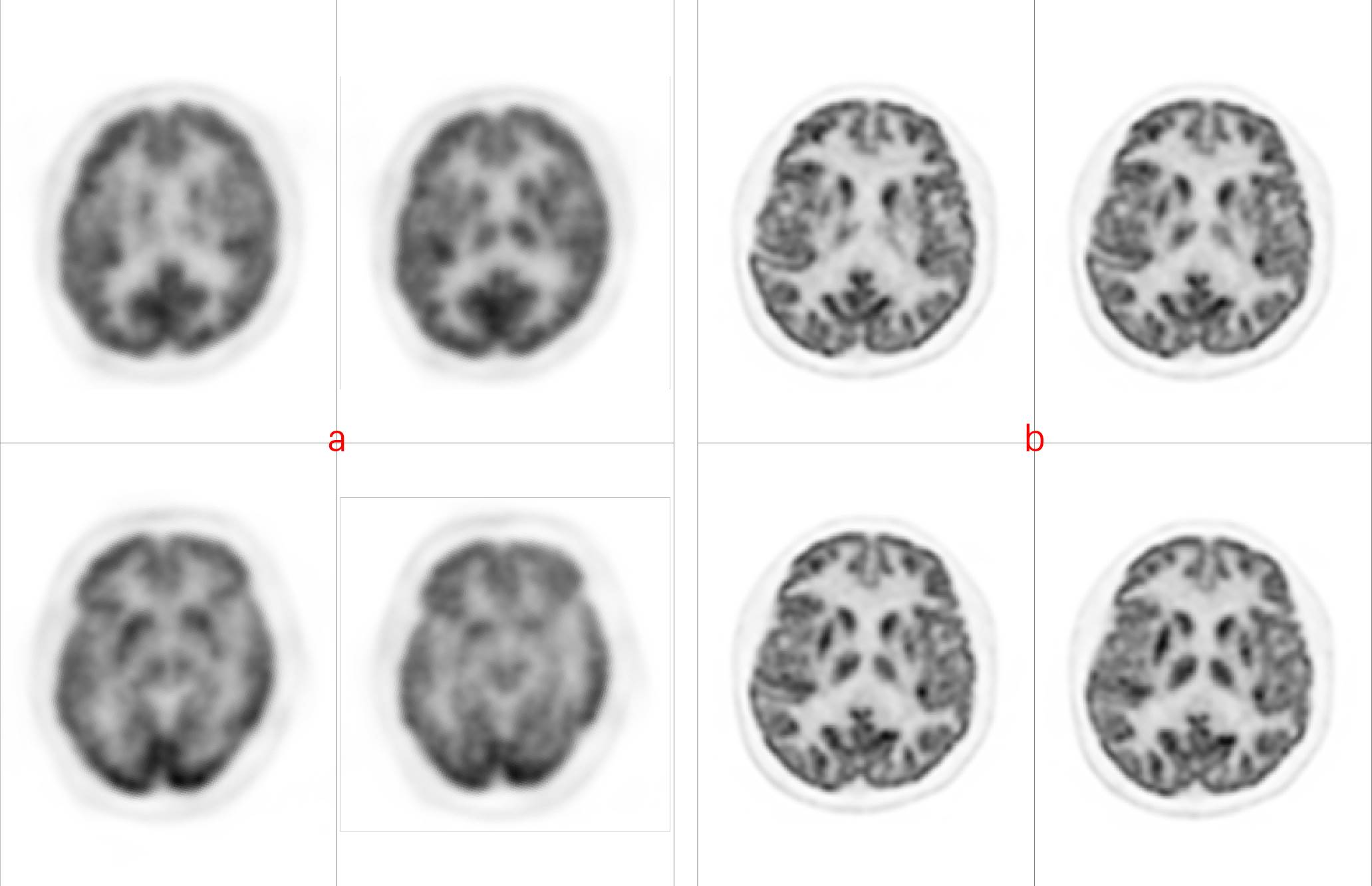 uMI 780 | Ultra-Fast High-Resolution Digital PET/CT - ΠΑΠΑΠΟΣΤΟΛΟΥ