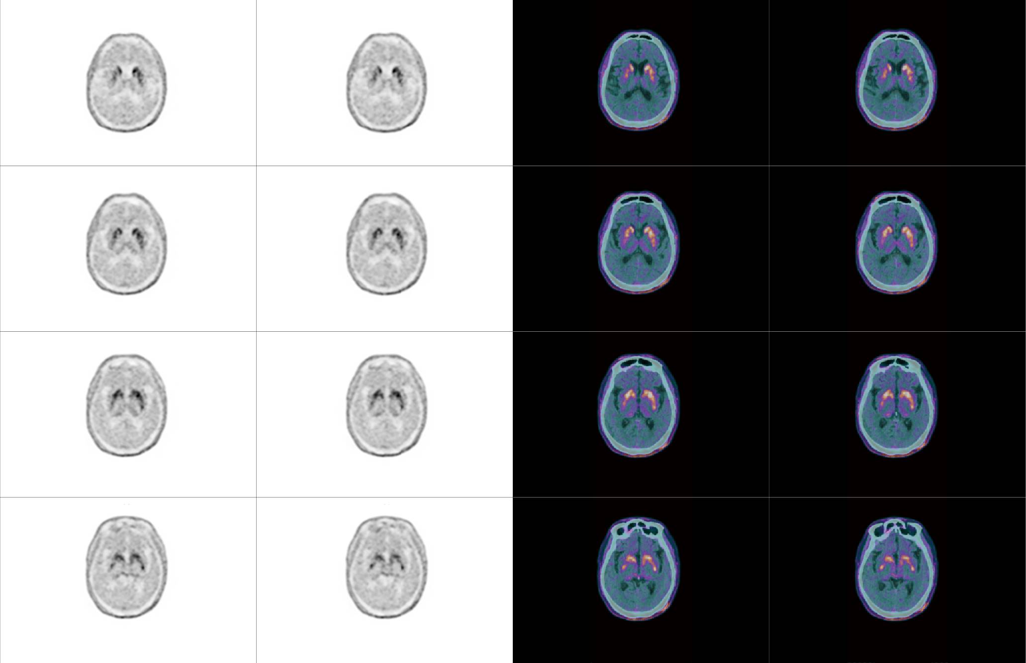 uMI 780 | Ultra-Fast High-Resolution Digital PET/CT - ΠΑΠΑΠΟΣΤΟΛΟΥ